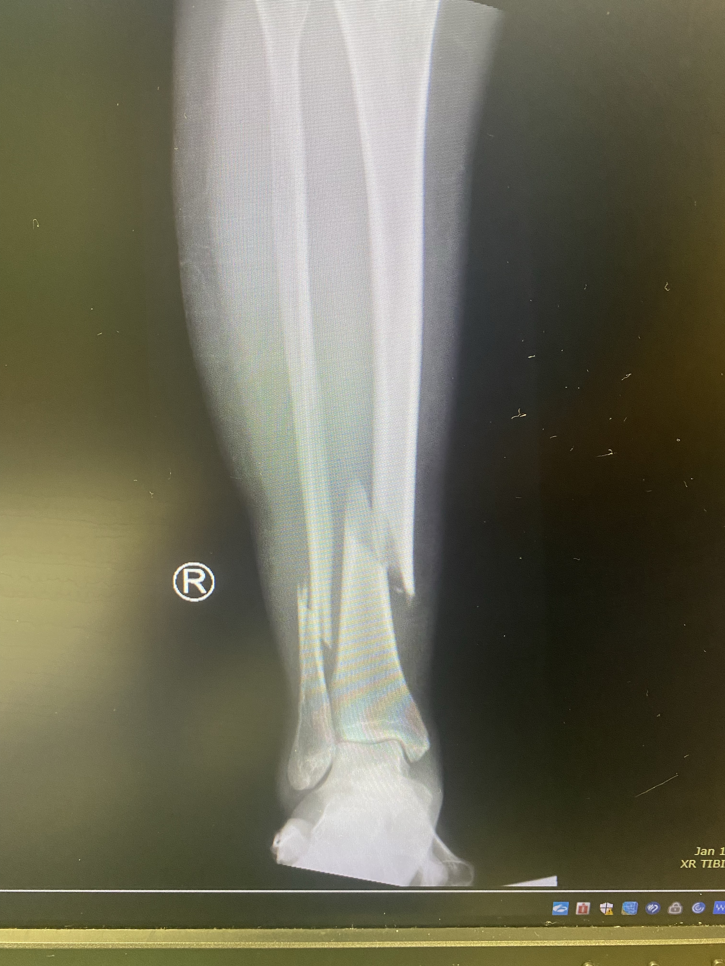 Broken Tibia and Fibula Lessons 1/18/2024 | carol whitney